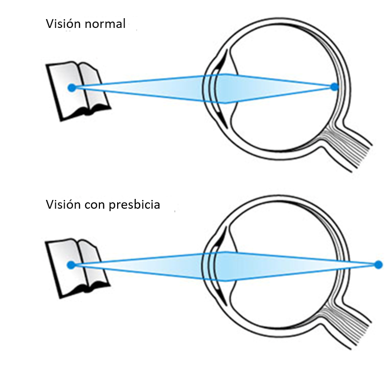 Presbicia | Clínica Mirabell
